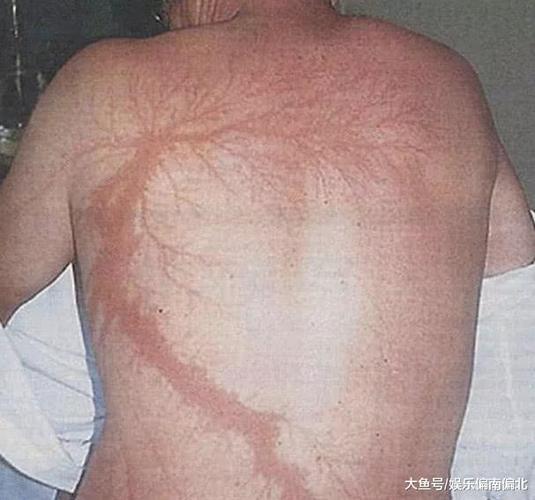 被雷劈存活的几率图标
