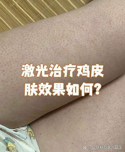 皮肤激光截图