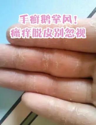 手癣照片图标