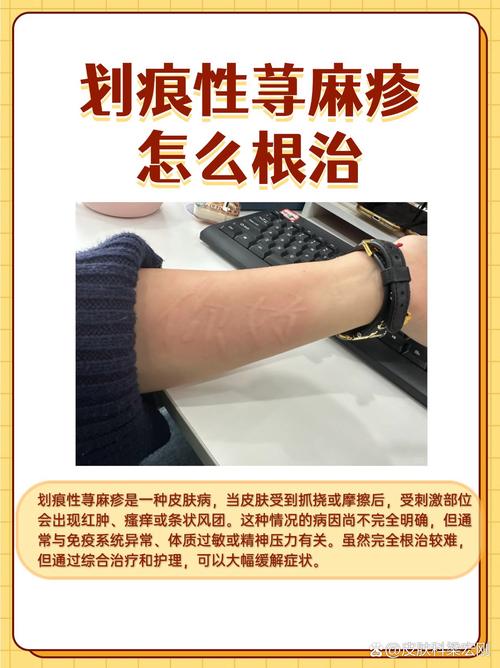 划痕症荨麻疹怎么治图标