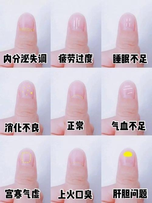 指甲有竖纹怎么办