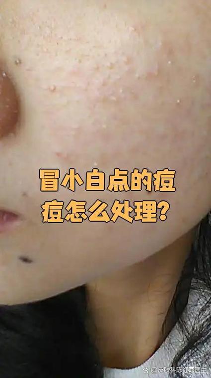 长白色的痘痘