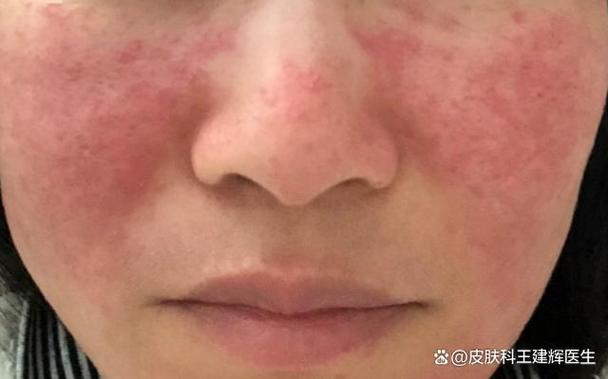 胳膊上有红色的斑印图标