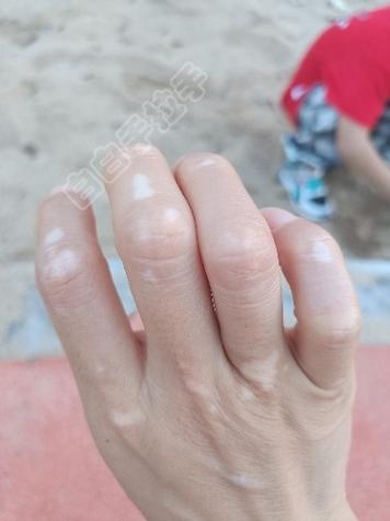 白白手拉手有治好的吗图标