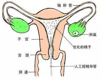 同房插不进去可以人工授精吗截图