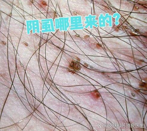 阴虱虫图标