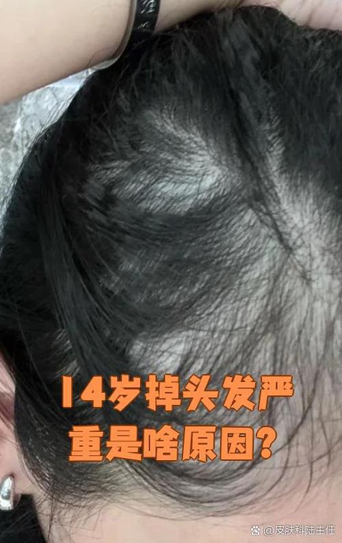 春季容易掉头发吗图标