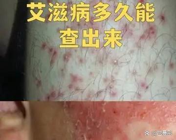 艾滋病感染多久才知道图标
