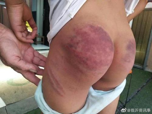 挨板子屁股肿烂图标