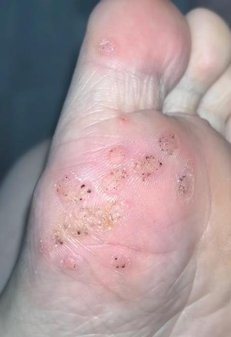 跖疣的传播途径图标