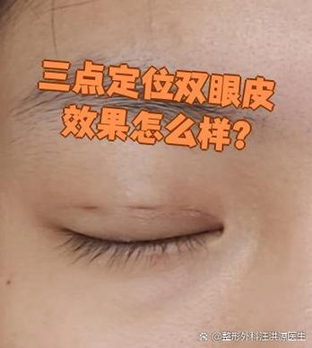 三点双眼皮能维持几年图标