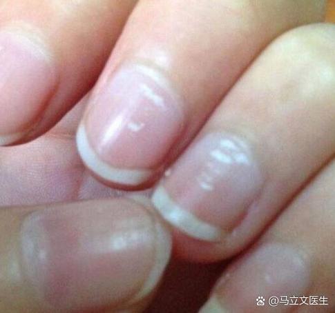 手指上有白色斑点是什么原因