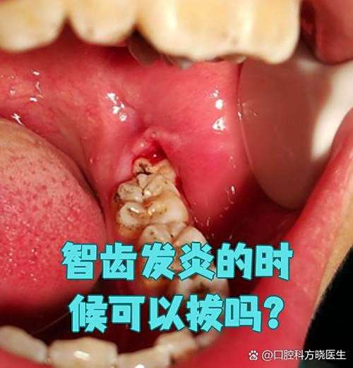 智齿发炎了能拔牙吗图标