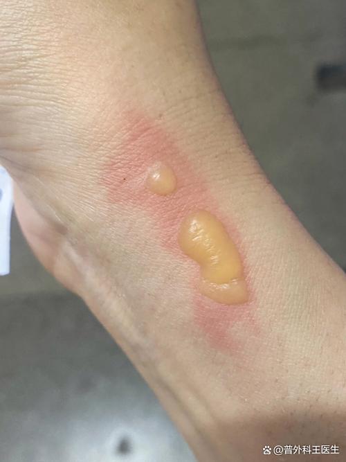 烫伤一般几天停止出水截图