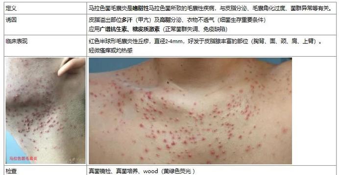 毛囊炎如何快速消退图标