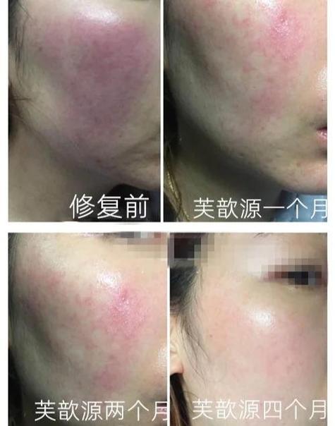 过敏怎么快速消除截图