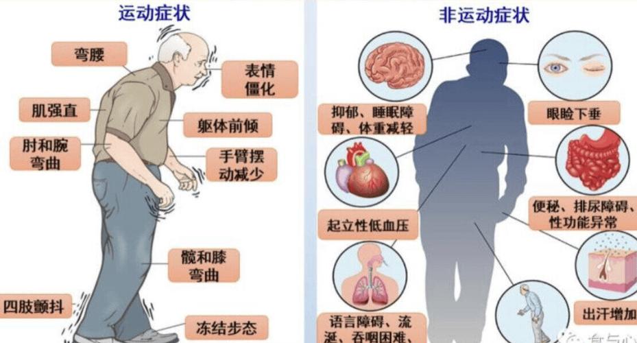 帕金森是什么症状图标