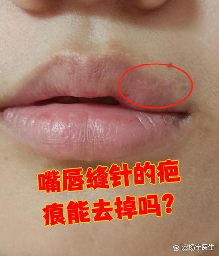 嘴唇缝了针多久能恢复疤痕截图
