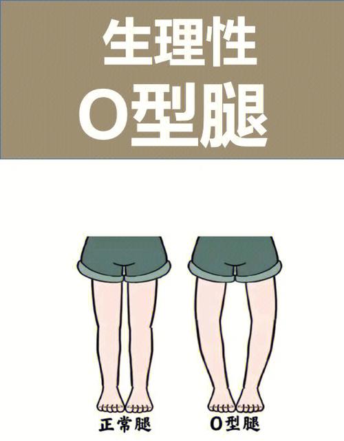 O型腿怎么走路图标