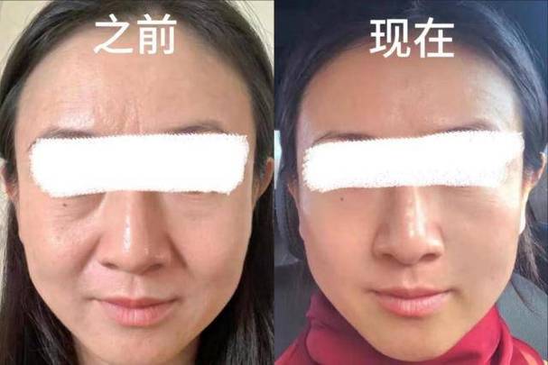 满脸皱纹最有效去皱方法图标
