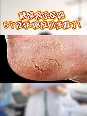 糖尿病恶化的前兆20种图标