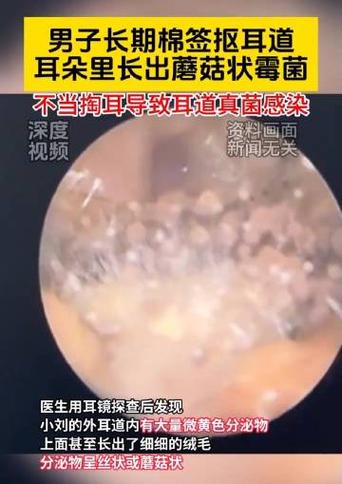 无线耳机耳屎怎么清理截图