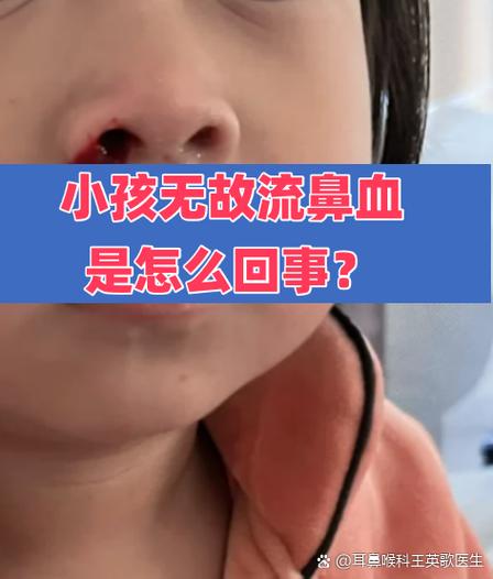 小孩子流鼻血脸上有红点是怎么了截图