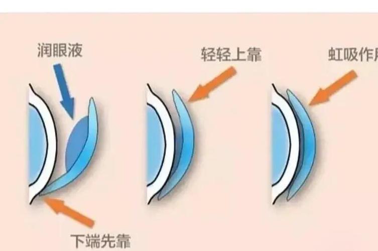 戴ok镜的好处与坏处缩略图