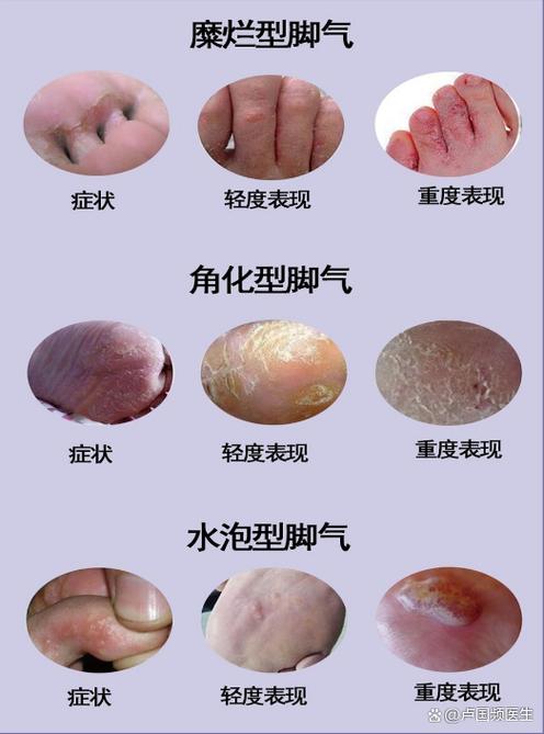 脚气照片