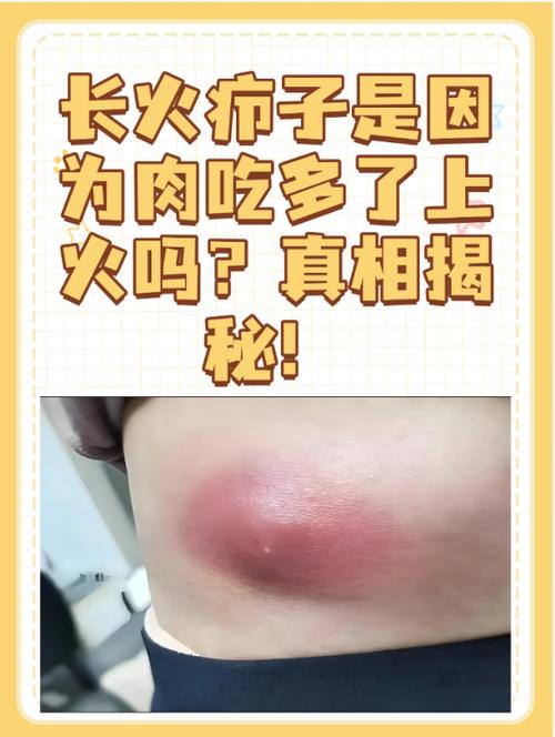总长火疖子是怎么回事图标