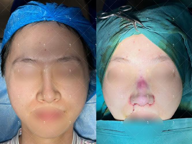 我后悔了做鼻中隔手术图标