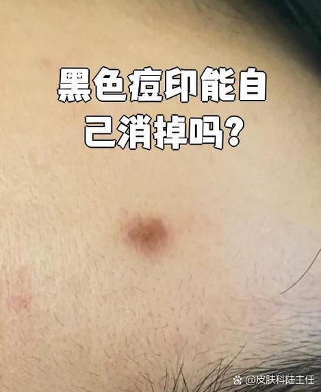 痘印会自己消失吗图标