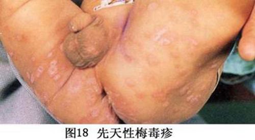 梅毒早期图片截图