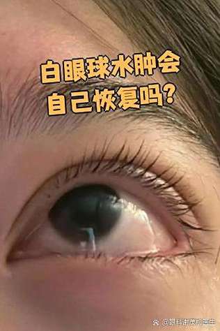 视力会自己慢慢恢复吗图标