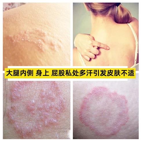 身子痒一抓就起小疙瘩怎么办截图