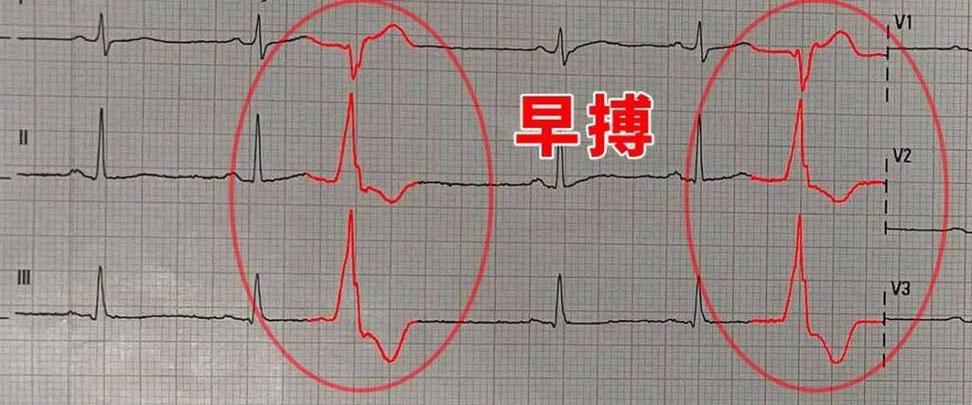 焦虑症唯独害怕早搏截图