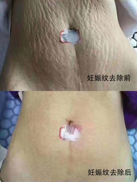 如何去除妊娠纹图标