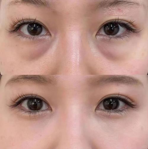 去黑眼袋图标