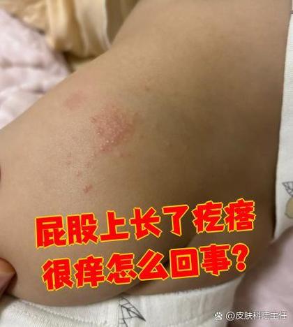 臀部出现风团疙瘩瘙痒图标
