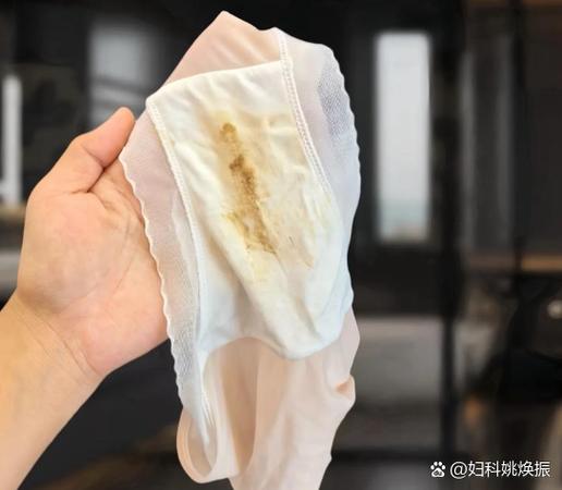 白带发黄粘稠是什么原因图标