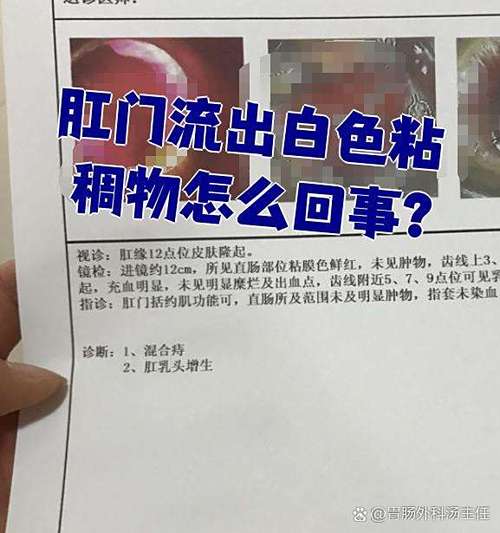 肛门流白色粘液是什么原因图标
