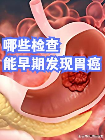 hp是胃癌早期症状吗图标