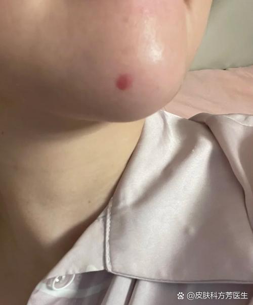 红印子多久才能恢复图标