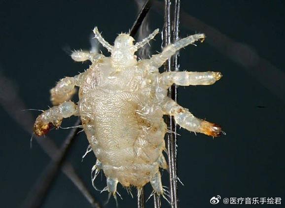 阴虱虫怎么根除截图