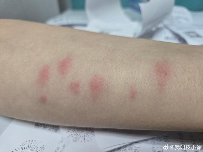 全身长红包很痒是怎么回事图标