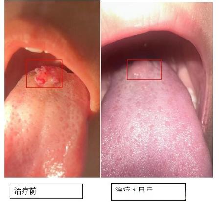 包块无明显血流信号是什么意思截图