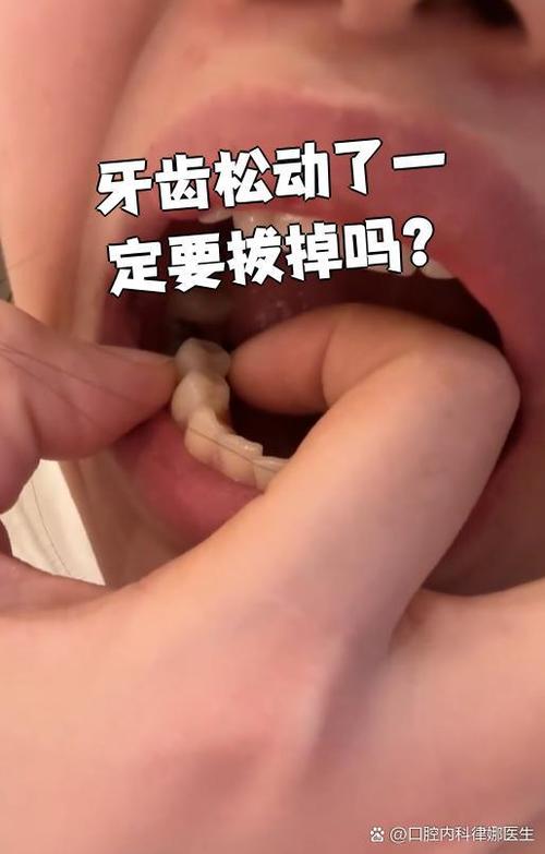 牙齿松动拔掉好吗截图