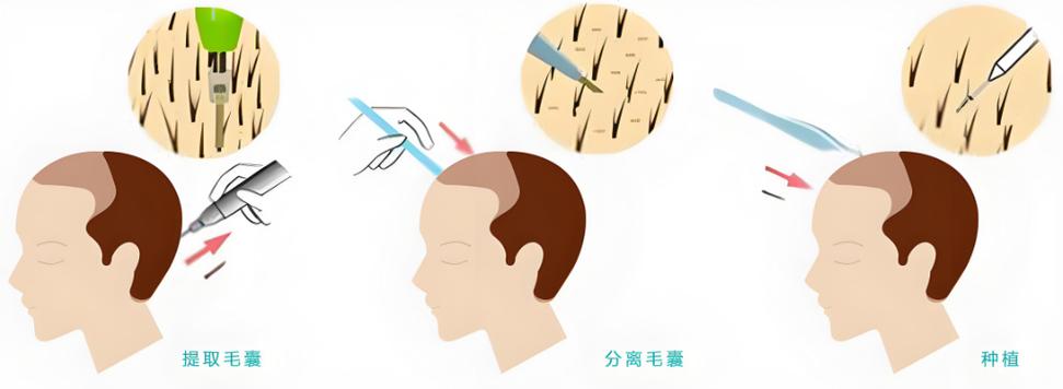种发植发哪个医院好图标