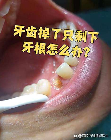 牙齿断了只剩一点牙根截图