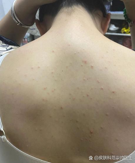 长痘痘的说说幽默图标
